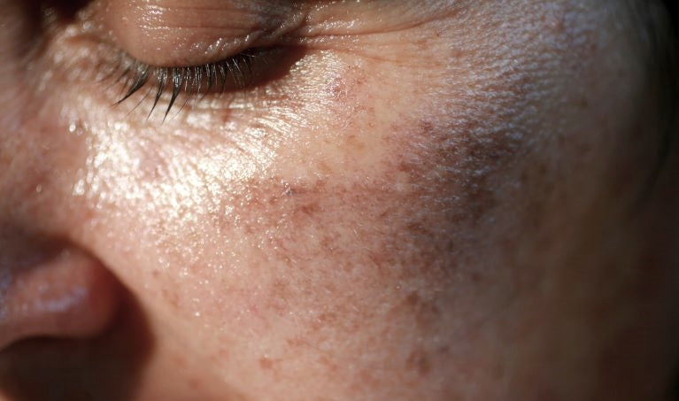 How to Get Rid of Crows Feet– Nakin Skincare