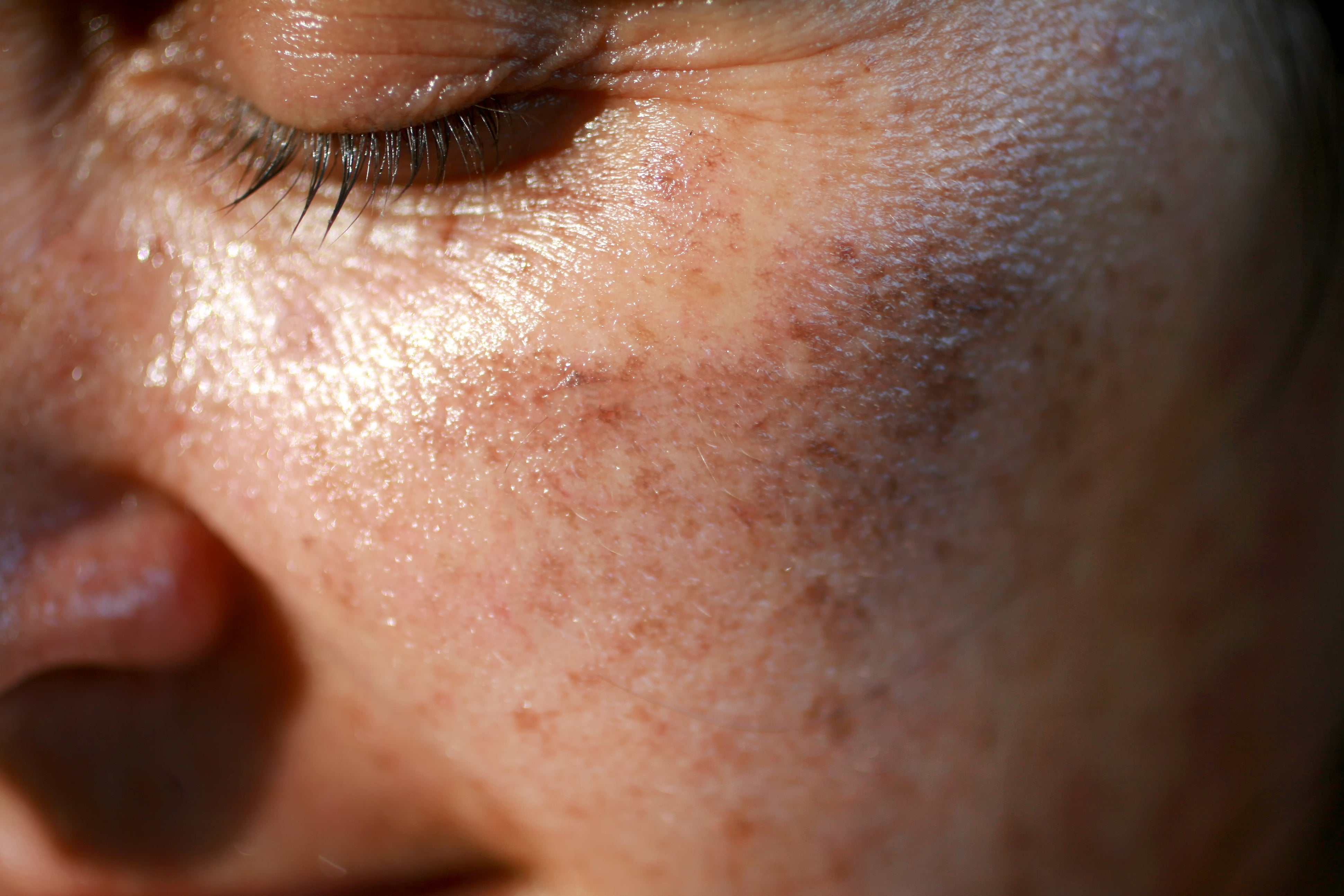 Why Does the Skin Around the Eyes Get So Dry– Nakin Skincare